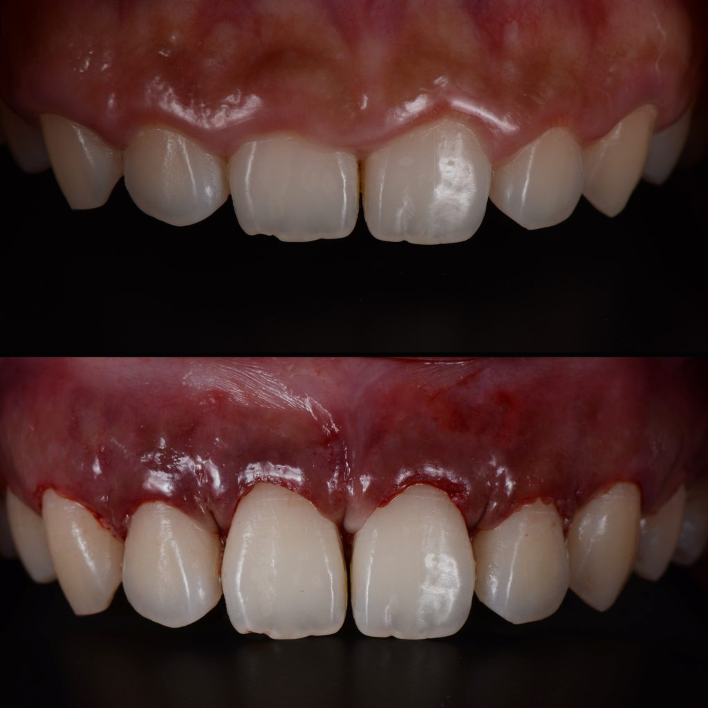 Gum Contouring | Dentist in Provo, UT